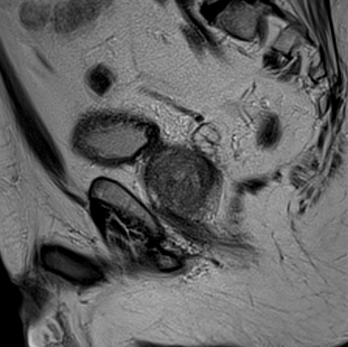 Prostate Mri T2 Sagittal High Resolution Images